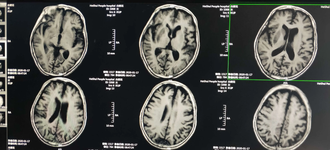 【OVERLORD】使用Paddle实现MRI医学图像超分辨率项目READ - 飞桨AI Studio星河社区